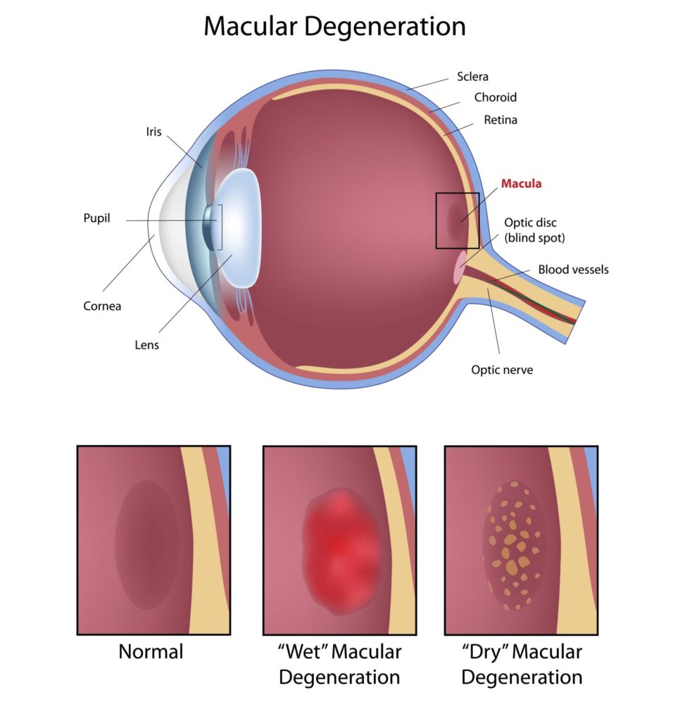 Age-Related Macular Degeneration - Retina Vitreous Consultants, Inc